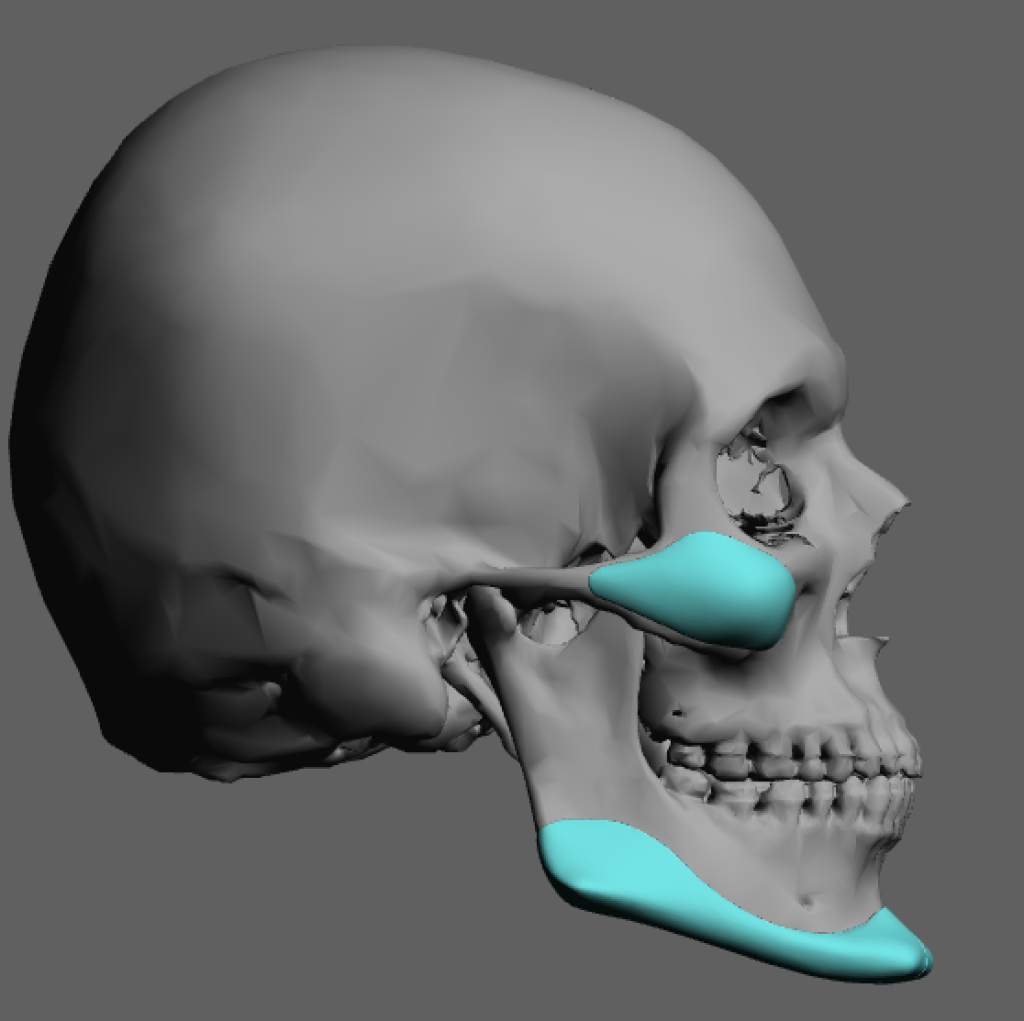Plastic Surgery Case Study - Male Custom Cheek and Jawline Implants ...