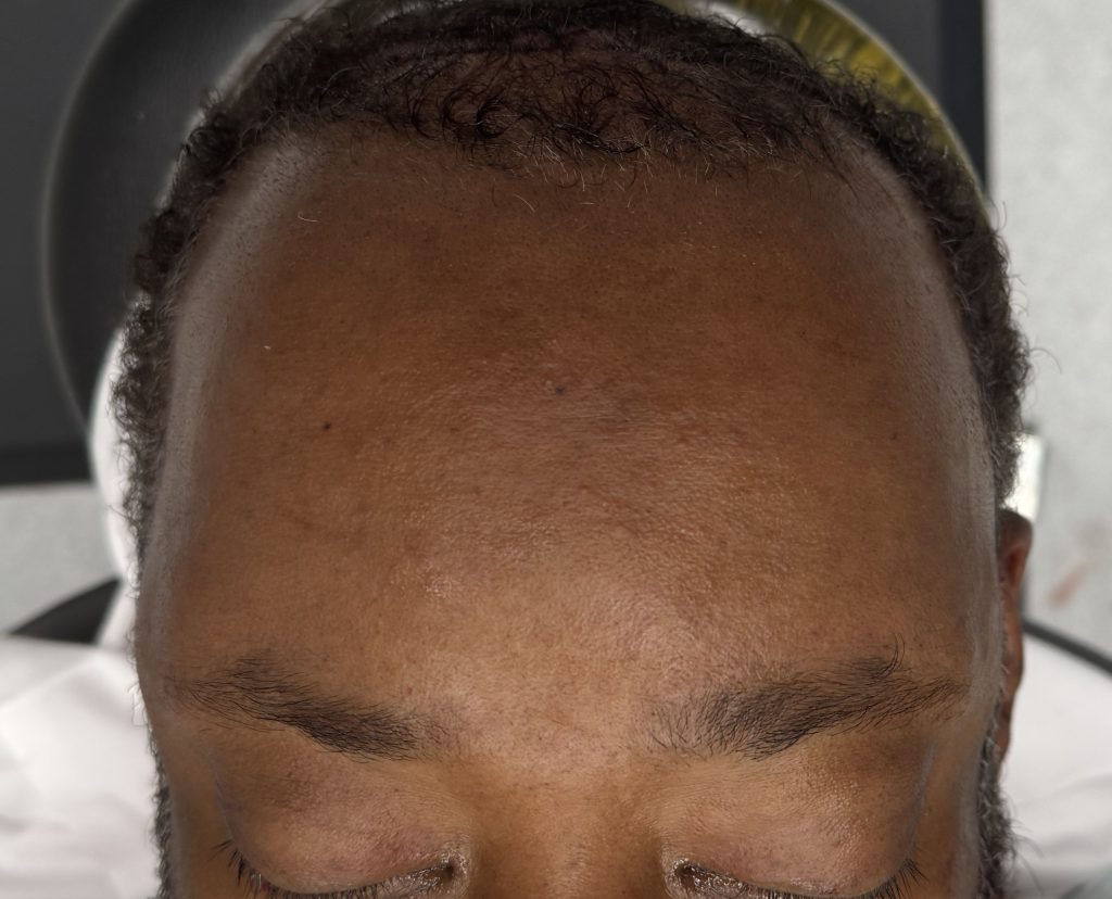 Plastic Surgery Case Study - Custom Extended Head Widening Implants for ...