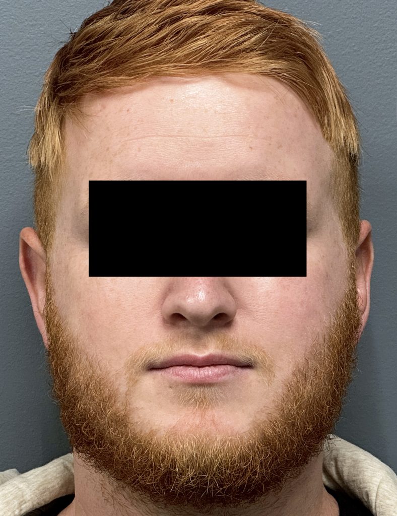 Plastic Surgery Case Study - Head Width Reduction with Temporal Bone and Muscle Removals ...