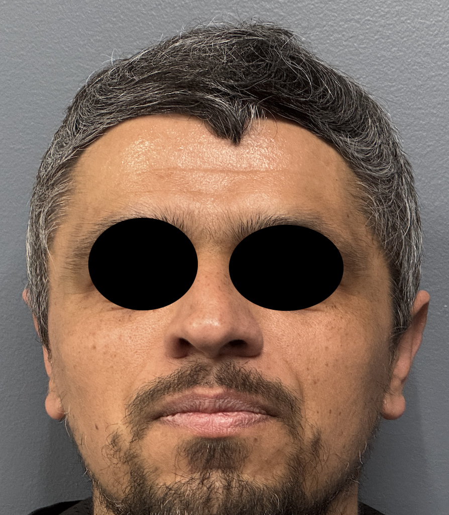 Plastic Surgery Case Study - Temporal Reductions in the Wide Convex ...