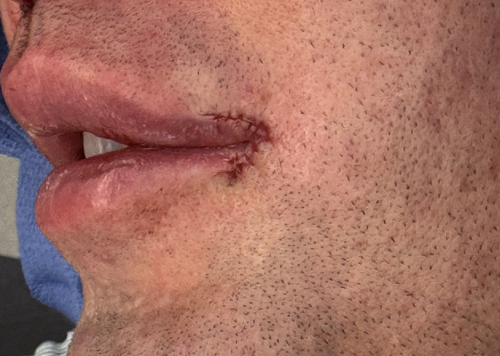 male mouth widening completed Dr Barry Eppley - Explore Plastic Surgery