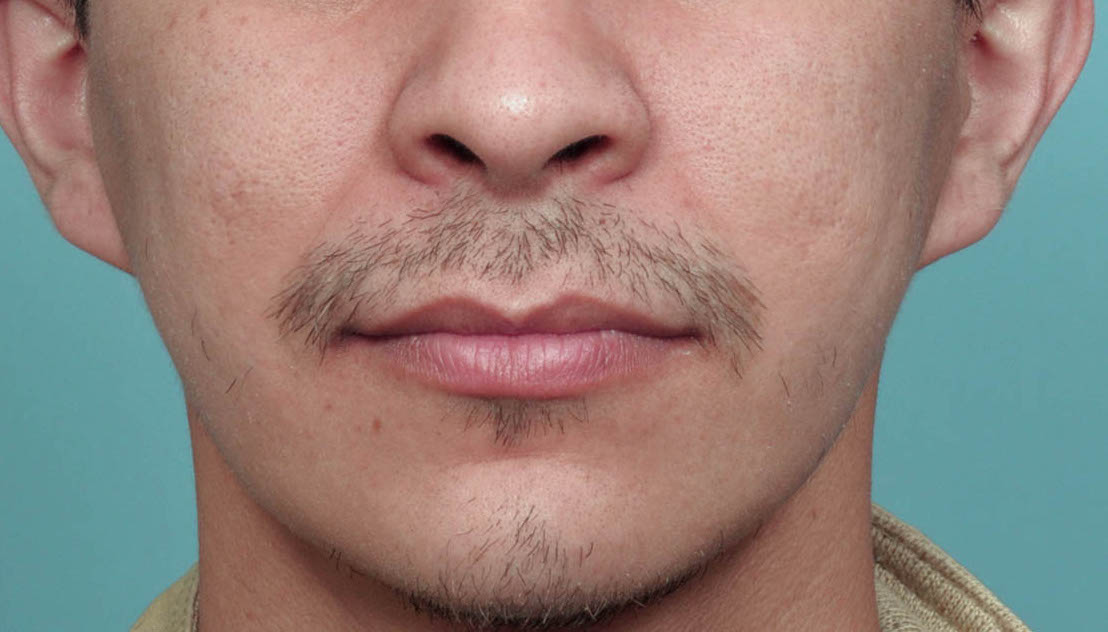 male soft tissuer cheek reduction front 1 Dr Barry Eppley_edited-1 ...