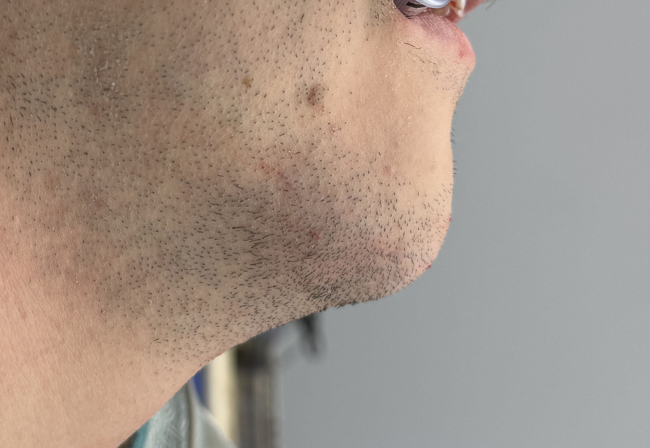 male weak chin side view intraop Dr Barry Eppley - Explore Plastic Surgery