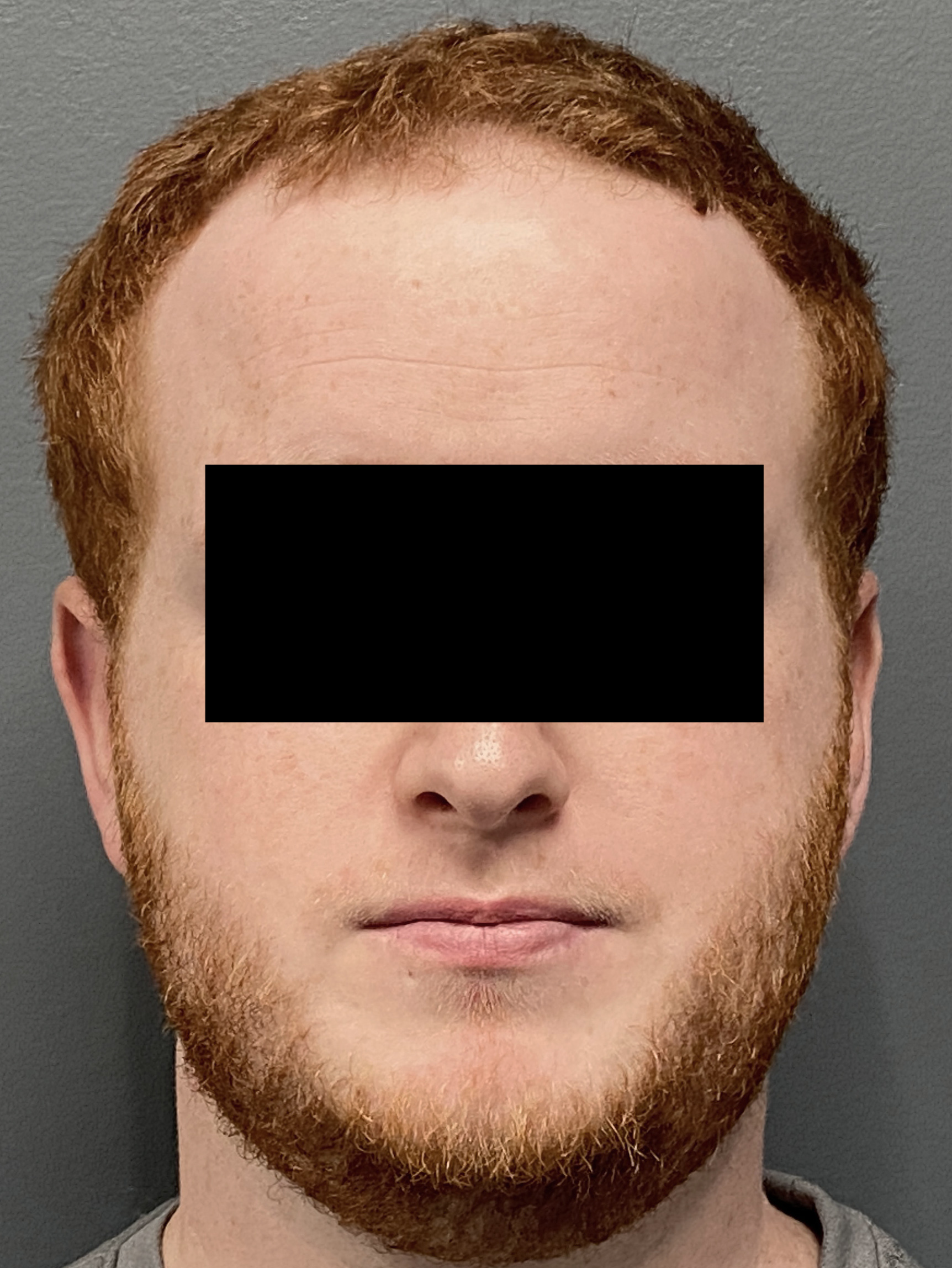 male wide head front 1 Dr Barry Eppley copy - Explore Plastic Surgery