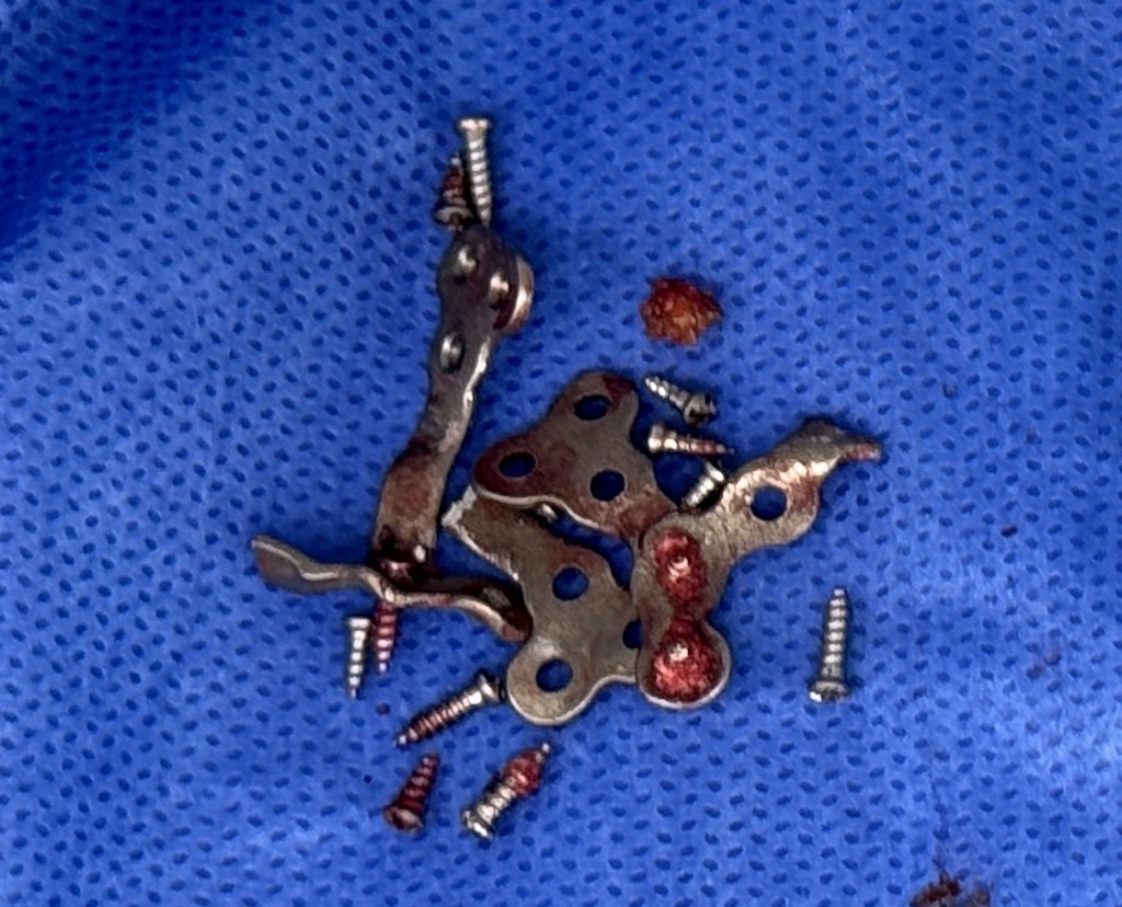 maxilary hardware removal Dr Barry Eppley - Explore Plastic Surgery