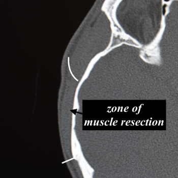 temporal reduction Archives - Explore Plastic Surgery