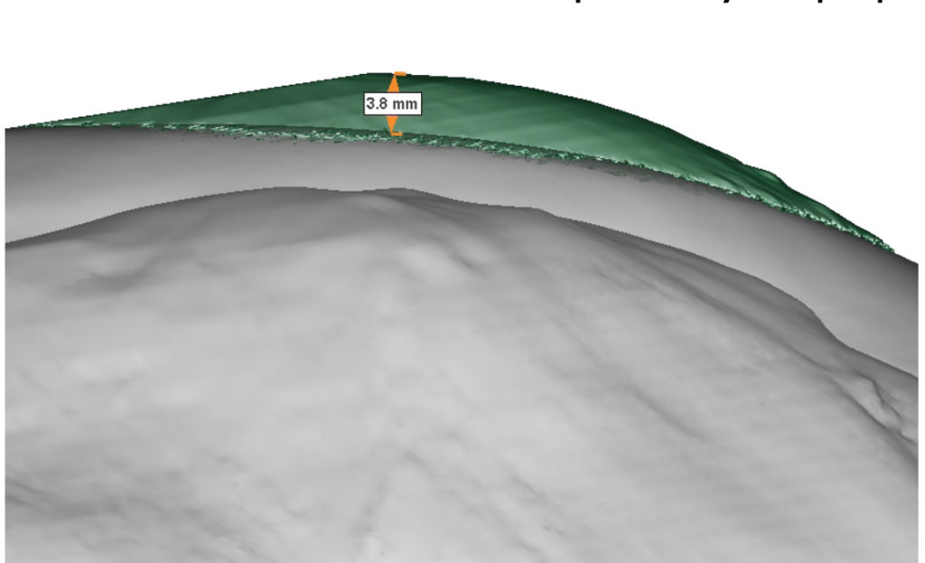 Plastic Surgery Case Study - Custom Extended Head Widening Implants for ...
