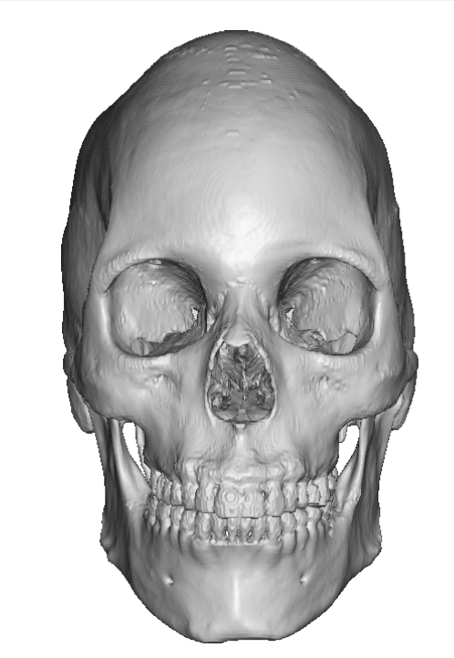 scaphocephalis head shape 3D Ct scan front view Dr Barry Eppley ...