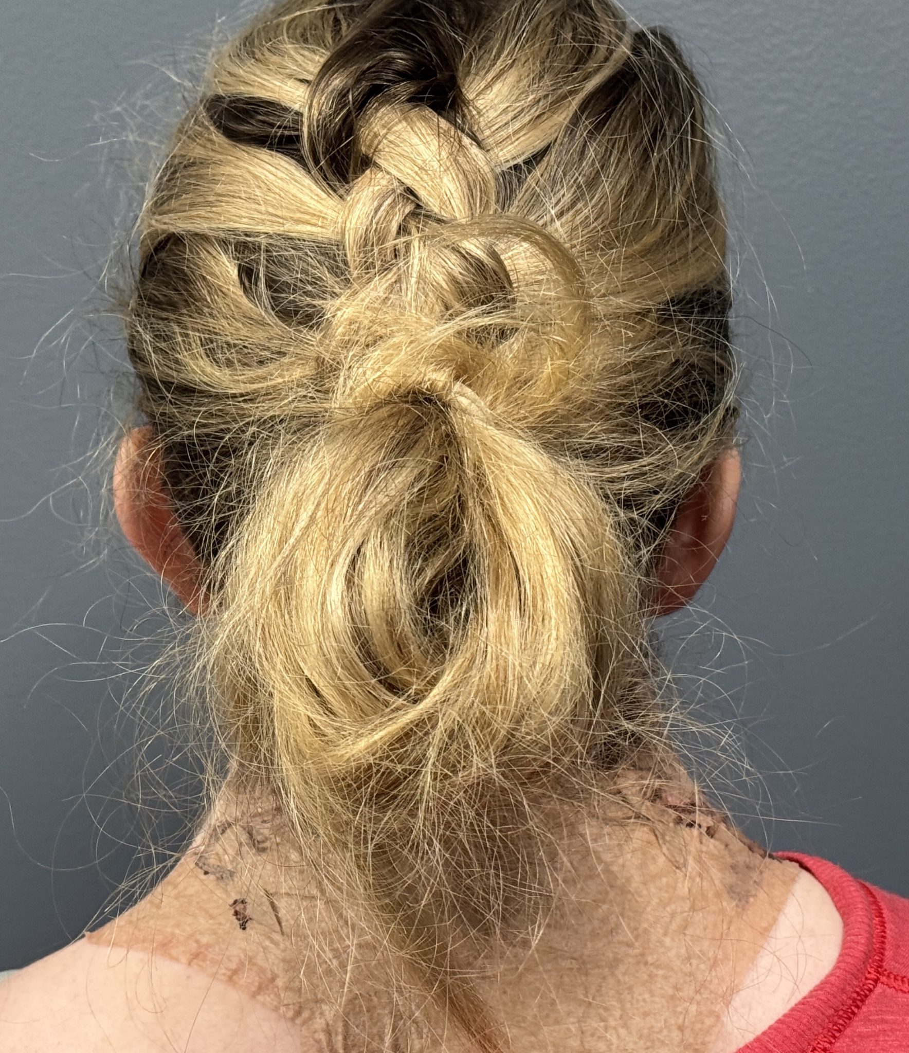 Plastic Surgery Case Study - Secondary Inverted T Posterior Approach ...