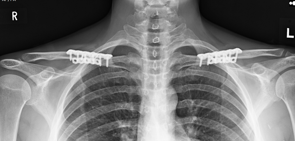 Plastic Surgery Case Study - The Clinical Significance of Clavicle Bone ...