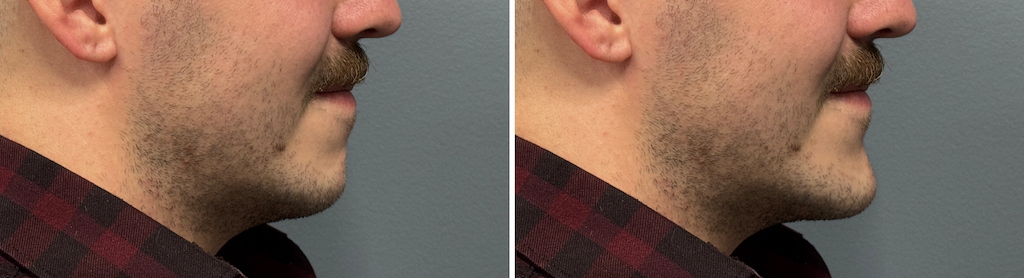 Plastic Surgery Case Study - Strong Male Chin Augmentation with a 10mm ...
