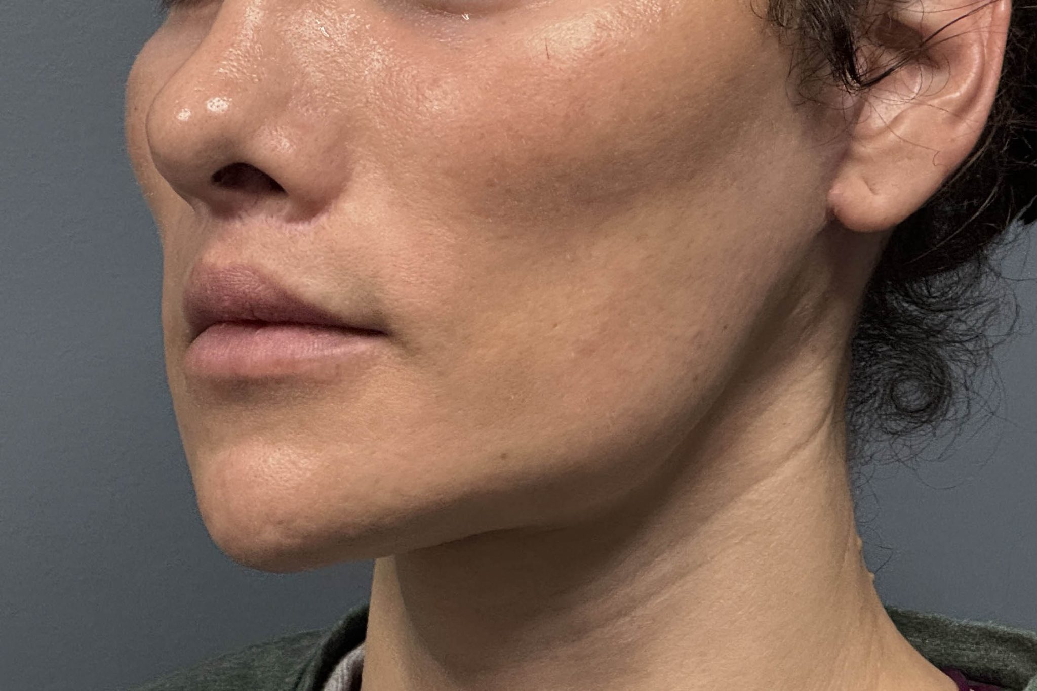 Plastic Surgery Case Study - Custom Jawline Implant for Secondary ...