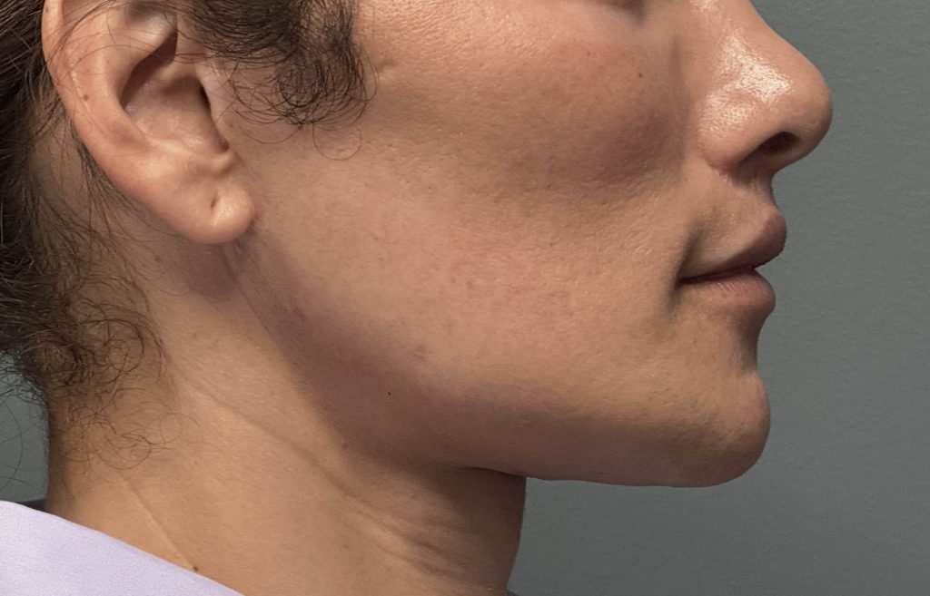Plastic Surgery Case Study - Custom Jawline Implant for Secondary ...