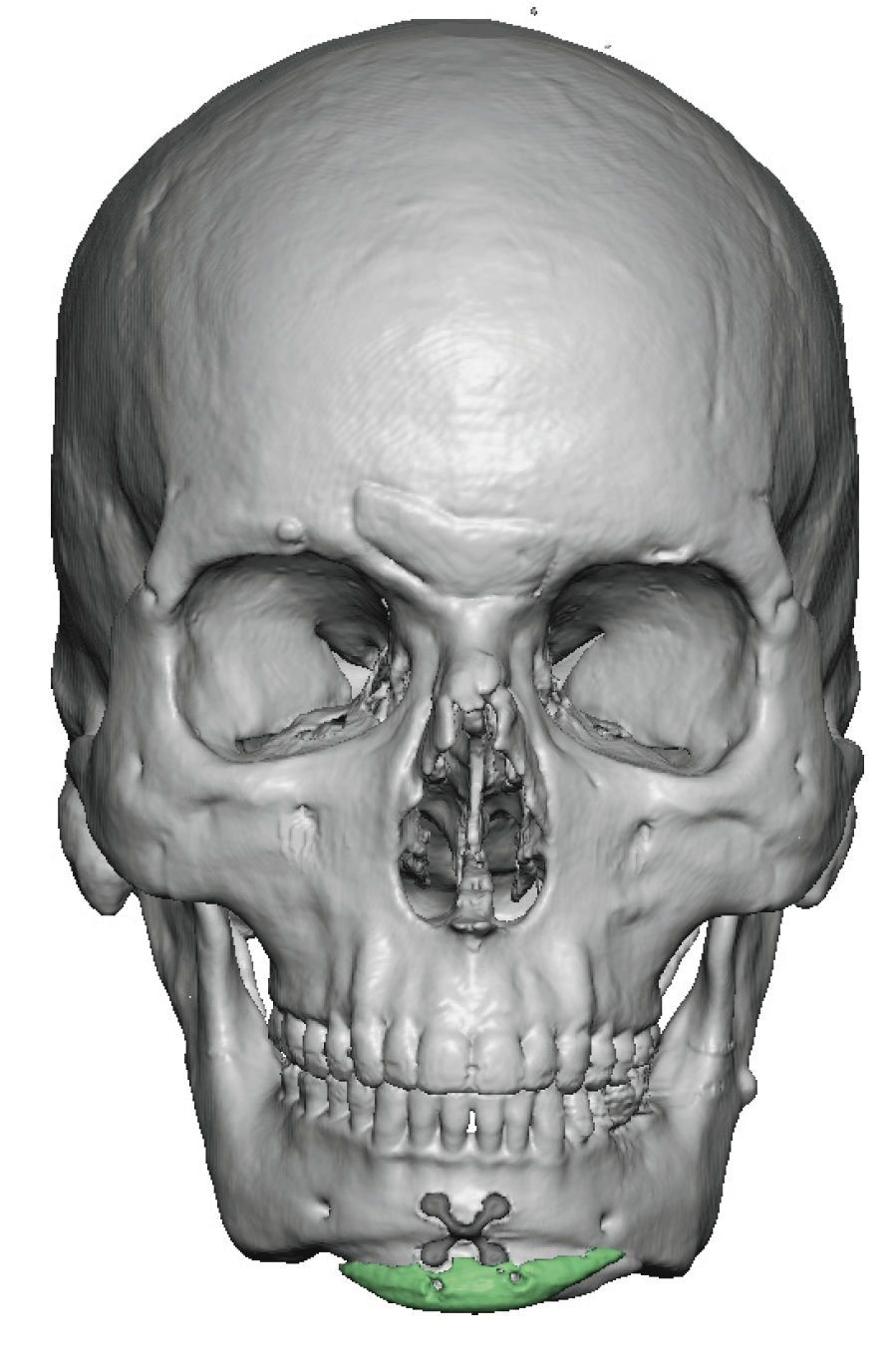 Plastic Surgery Case Study - Custom Jawline Implant for Secondary ...
