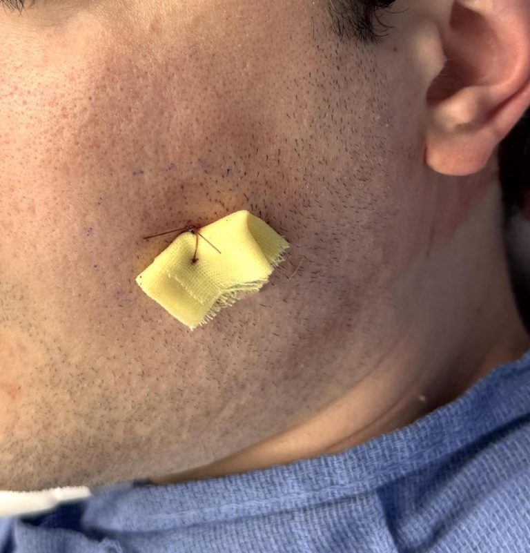 Plastic Surgery Case Study - Anatomic Buccal Lipectomy Reversal Using ...