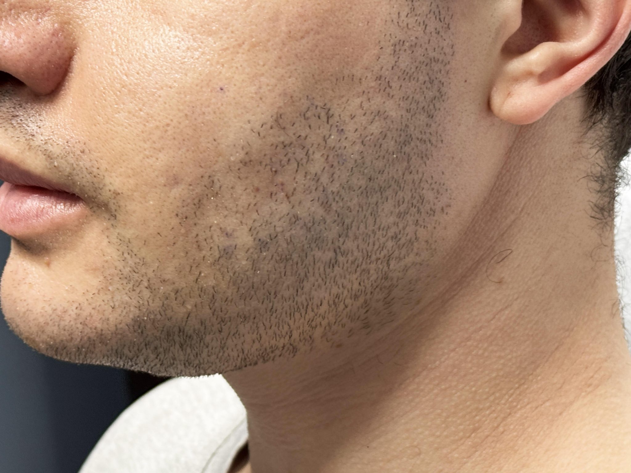 buccal lipectomy reversal left side postop Dr Barry Eppley - Explore ...