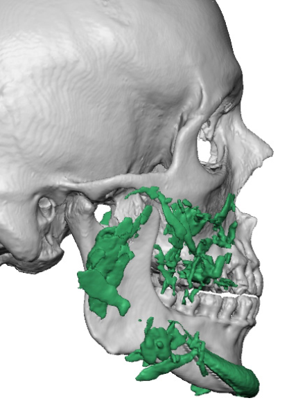chin implant and radiesse injector filler 3D CT scan side view Dr Barry ...