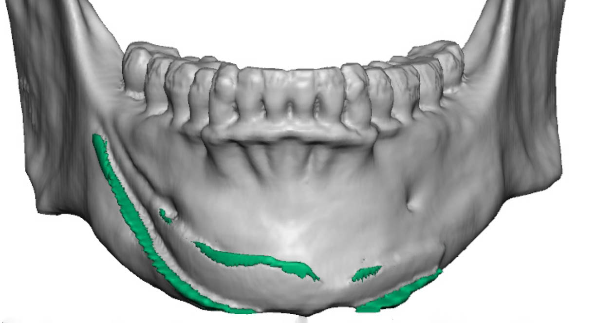 chin implant bony overgrowth 3D CT scan Dr Barry Eppley - Explore ...