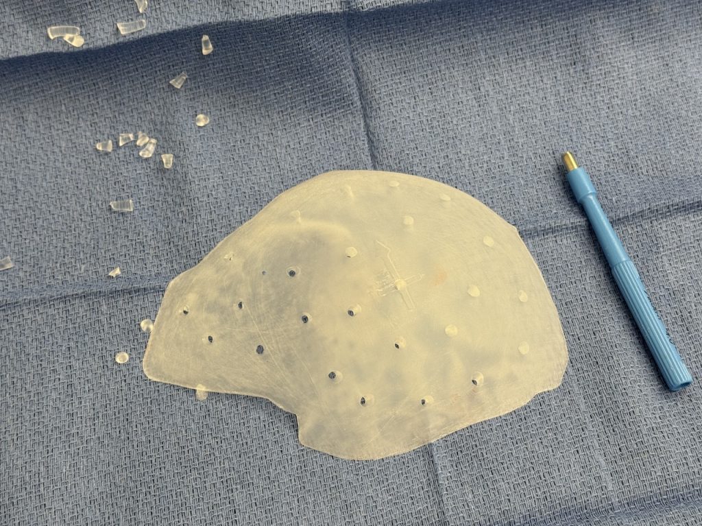 Plastic Surgery Case Study - Secondary Plagiocephaly Correction with ...