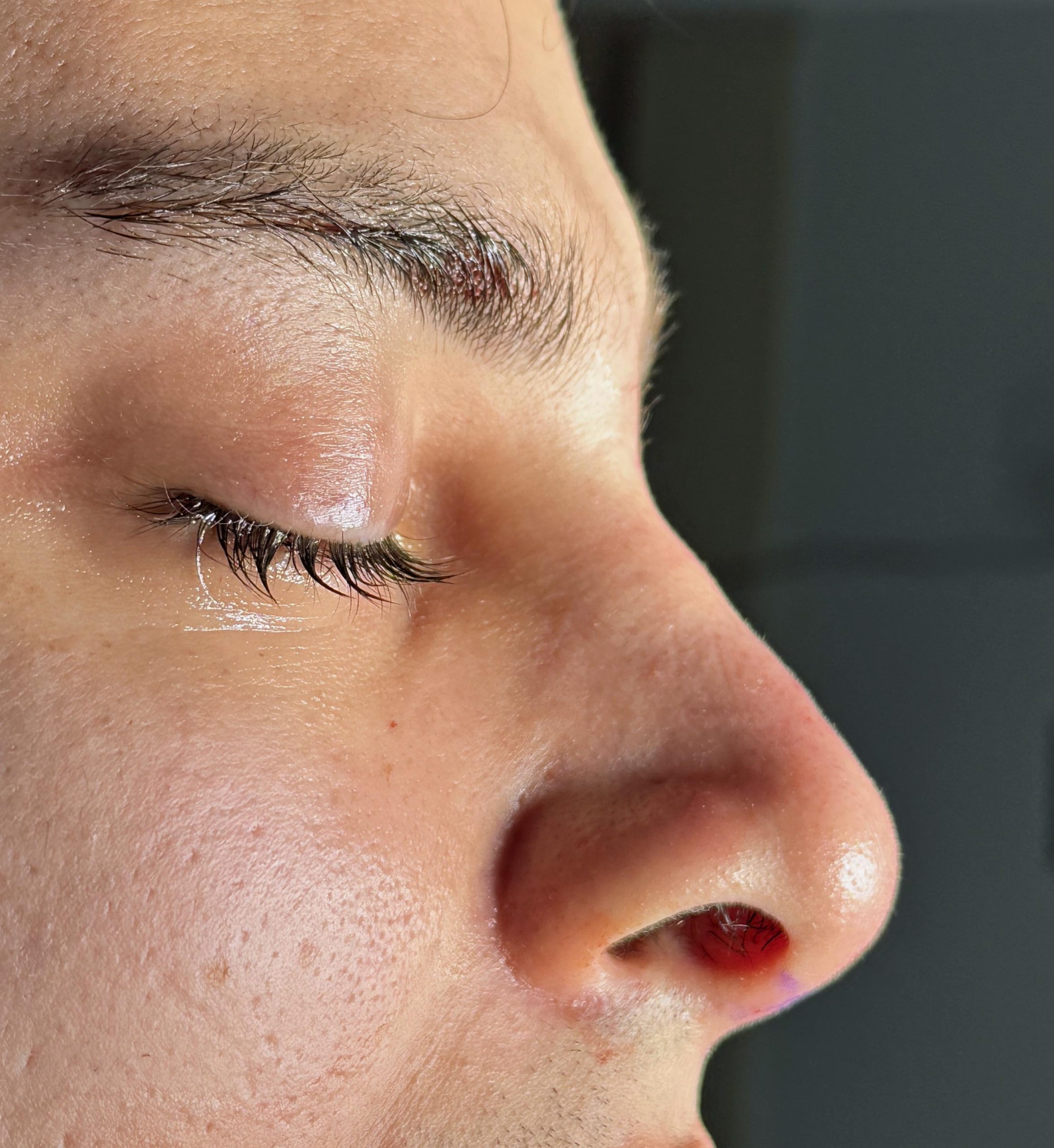 ePTFE dorsal augmentation rhinoplasty intraop side 1 Dr Barry Eppley ...