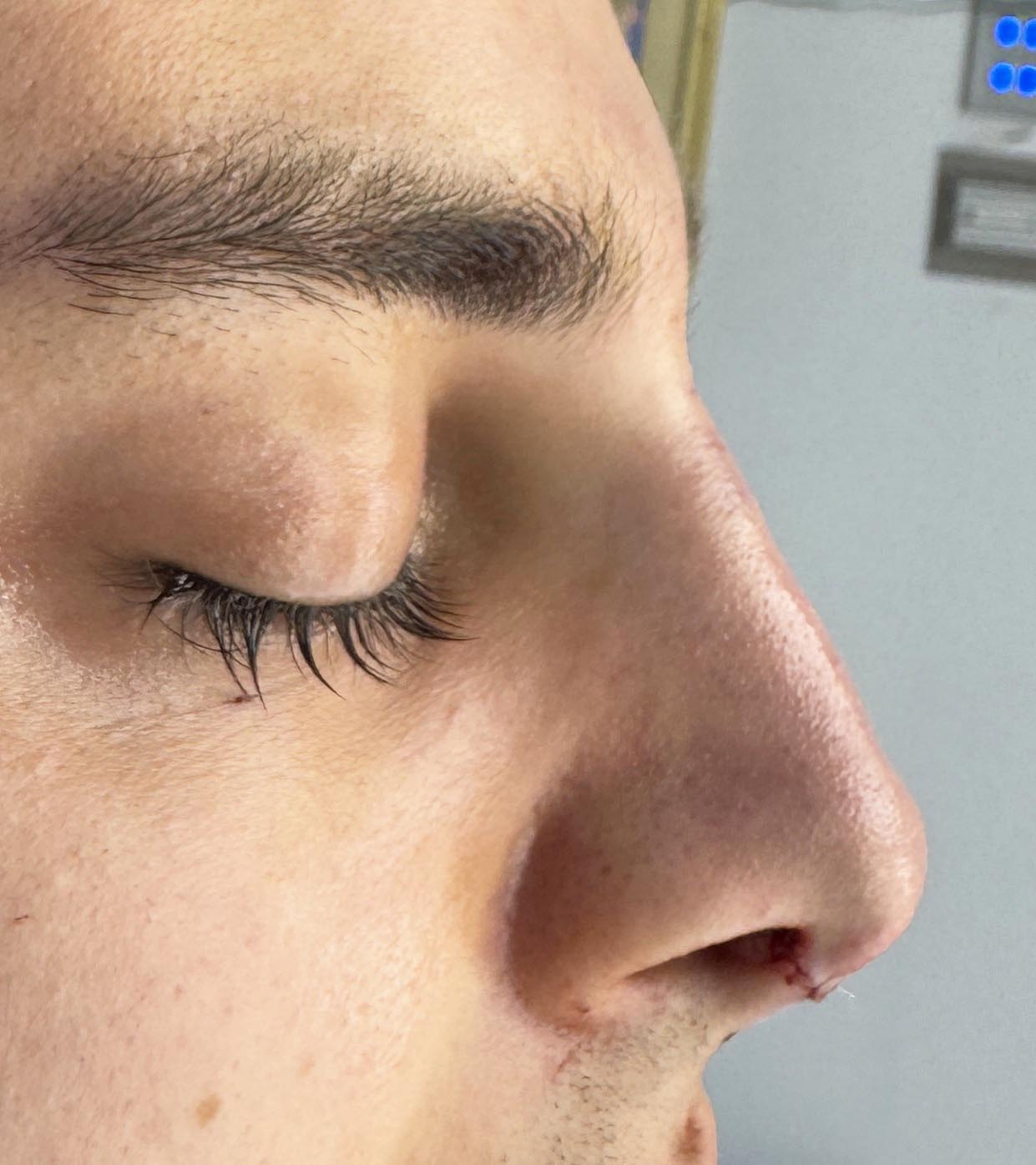 ePTFE implant dorsal augmentation rhinoplasty intraop side 2 Dr Barry ...