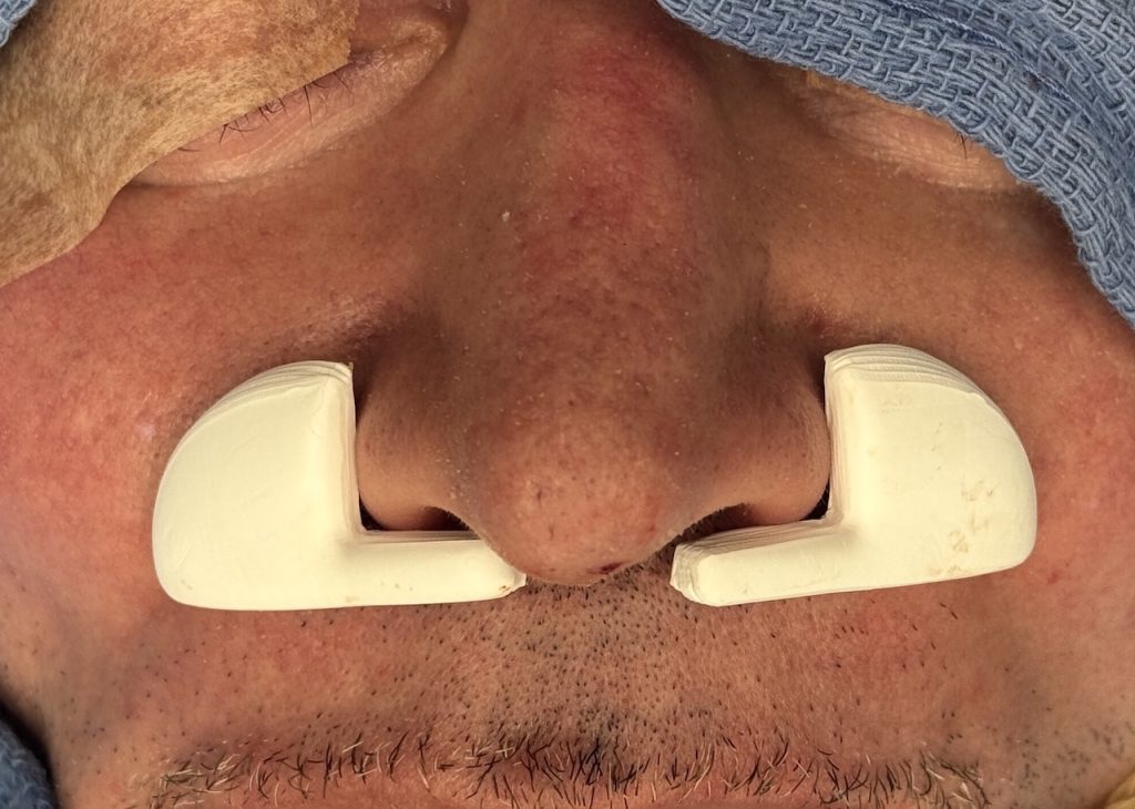 Plastic Surgery Case Study - Male ePTFE Paranasal Implants after Custom ...