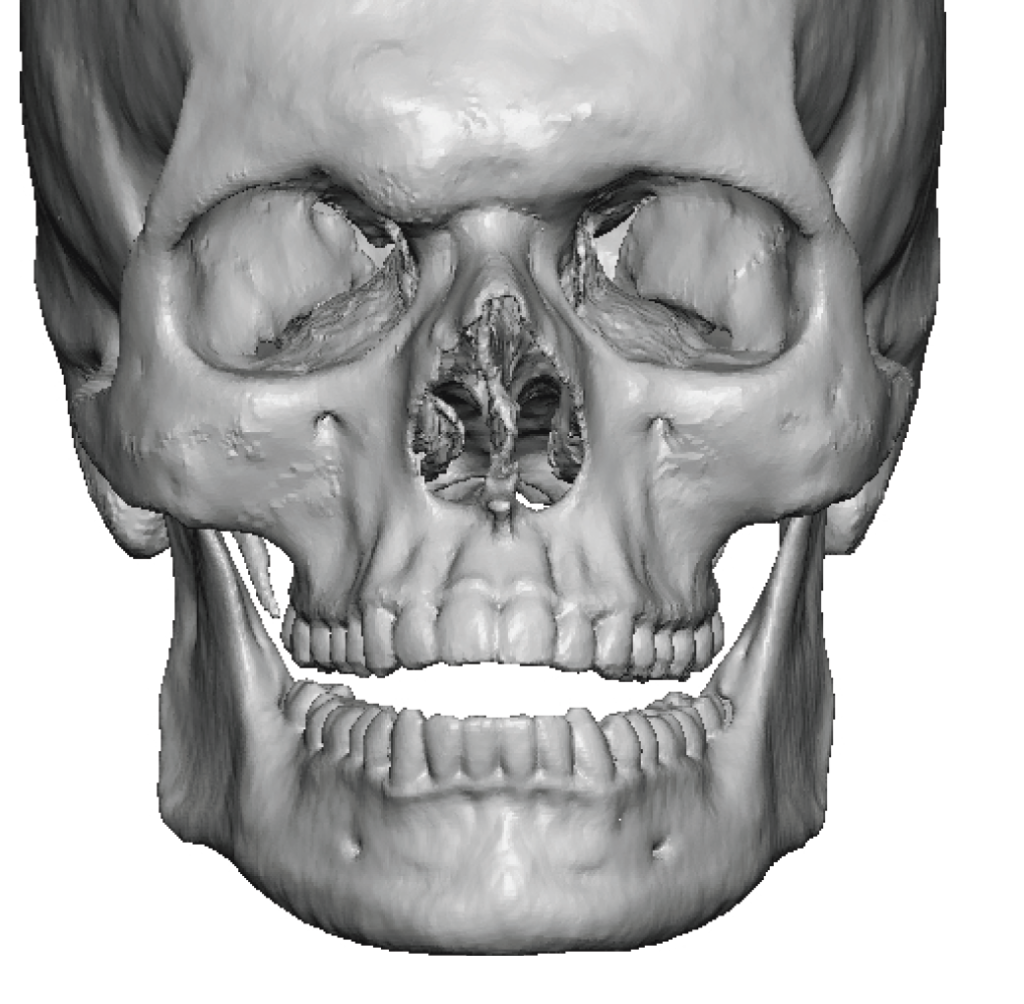 Plastic Surgery Case Study - Strong Jawline Implant Augmentation in the ...