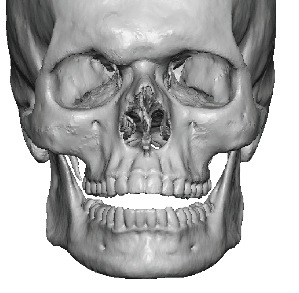 face 3D CT scan front view Dr Barry Eppley - Explore Plastic Surgery