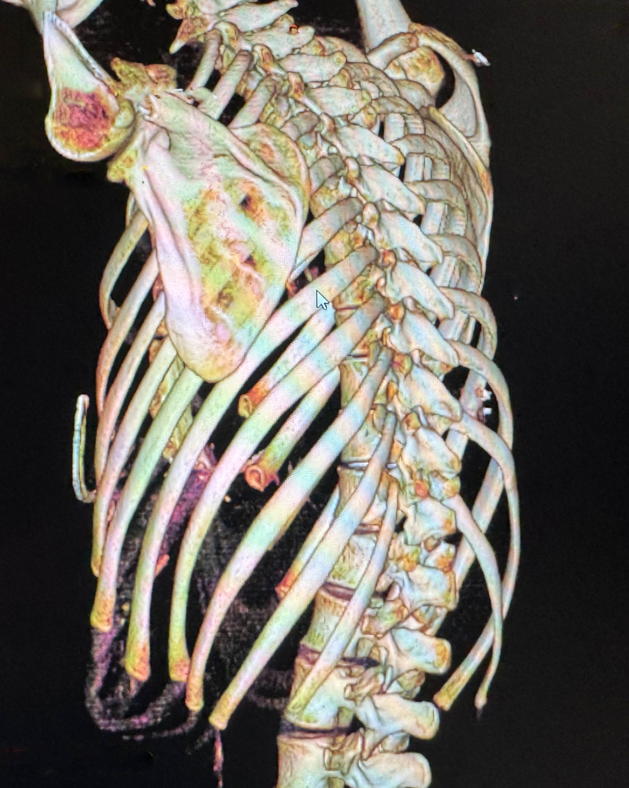 Plastic Surgery Case Study - Rib Remodeling for Right Subcostal Flare ...