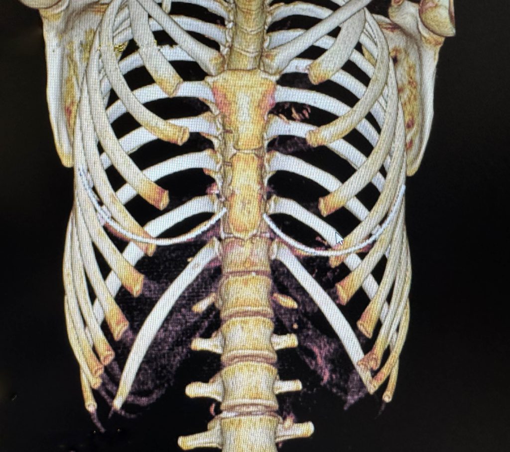 Plastic Surgery Case Study - Rib Remodeling for Right Subcostal Flare ...