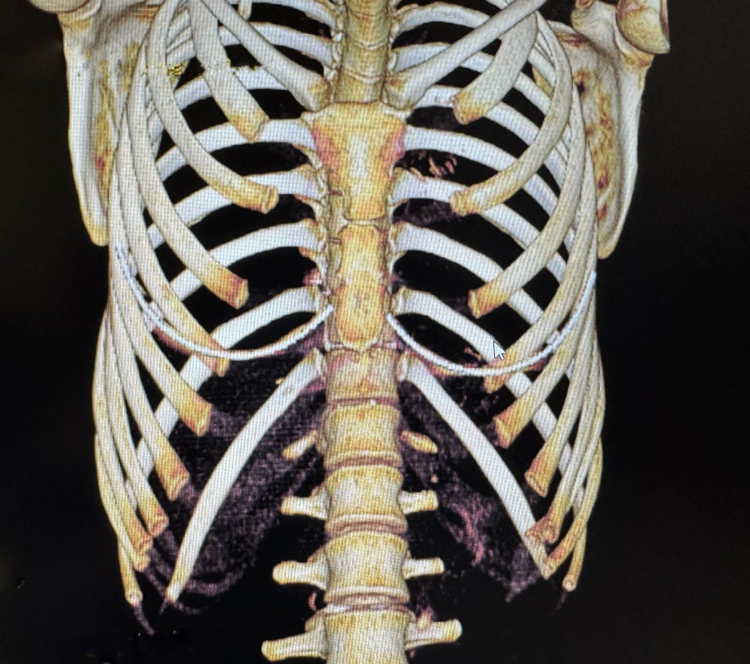 Plastic Surgery Case Study - Rib Remodeling for Right Subcostal Flare ...