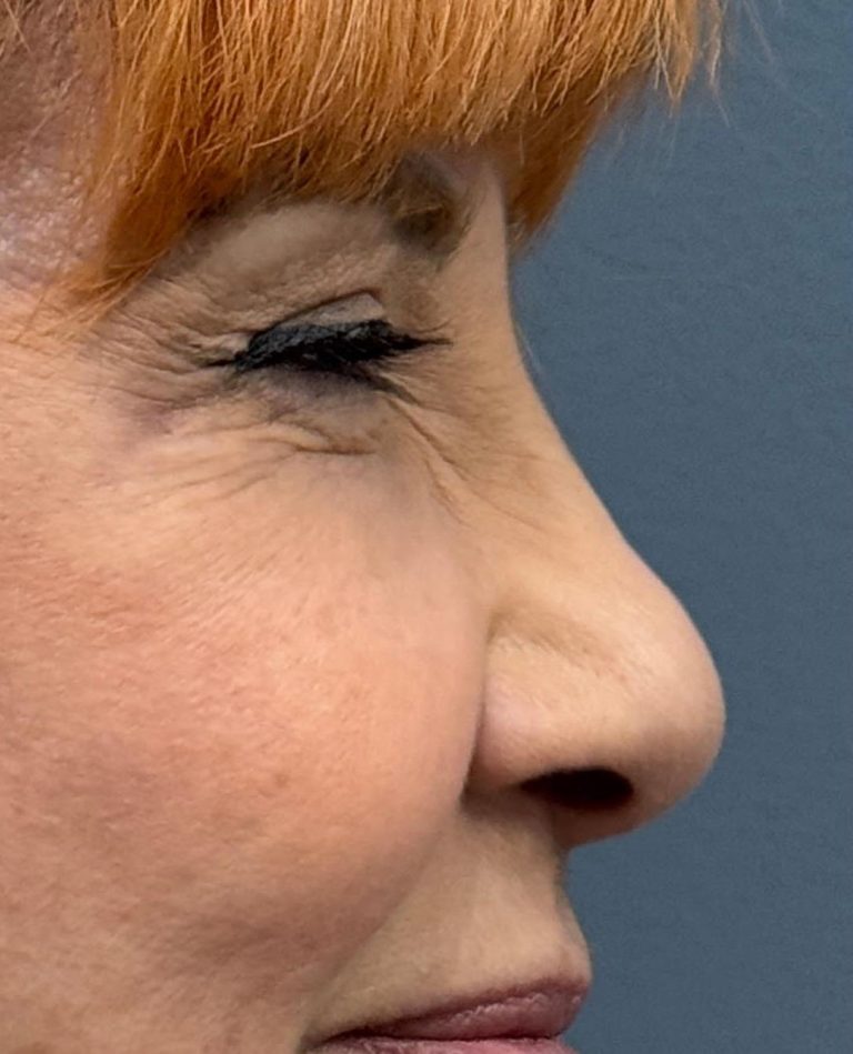 Plastic Surgery Case Study - The Older Barbie Nose Rhinoplasty ...