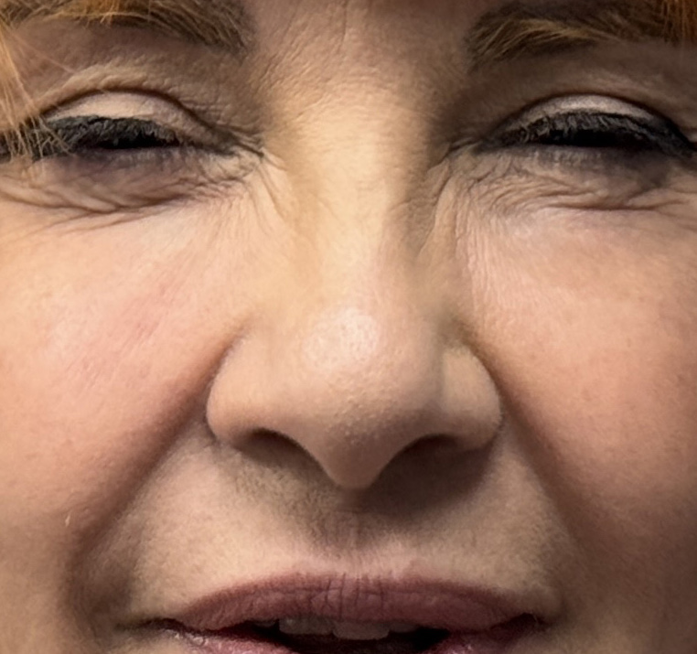 female barbie rhinoplasty front 1 Dr Barry Eppley copy - Explore ...