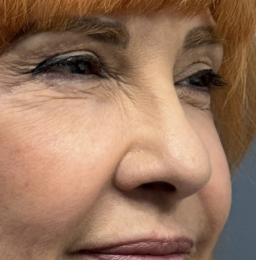 female barbie rhinoplasty oblioque 1 Dr Barry Eppley copy - Explore ...