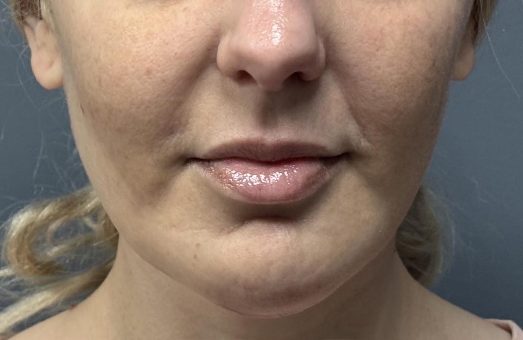 Plastic Surgery Case Study - Conversion of a Female Broad Standard Chin ...