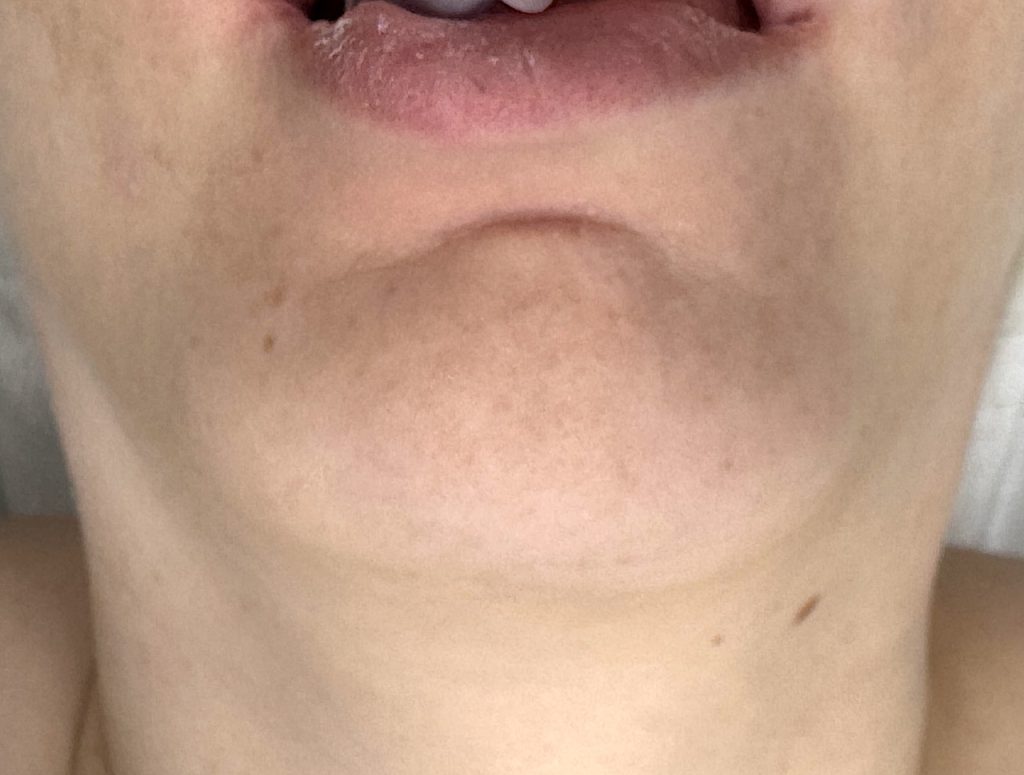 Plastic Surgery Case Study - Conversion of a Female Broad Standard Chin ...