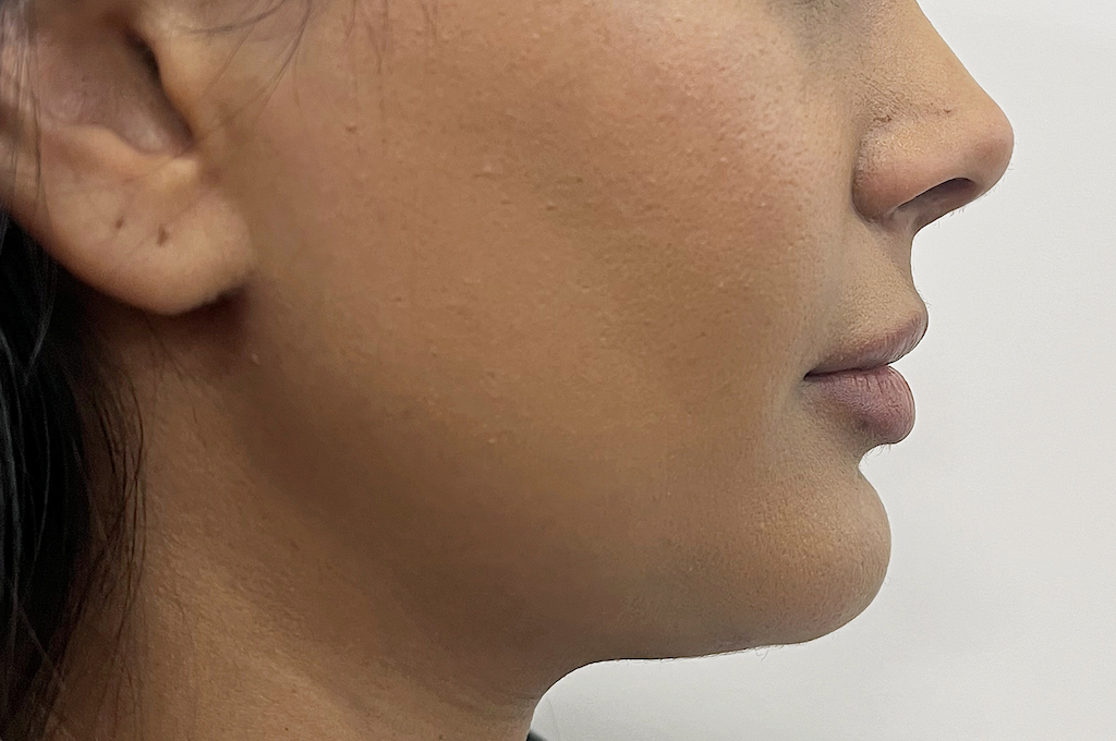 female chin reduction side 2 Dr Barry Eppley copy - Explore Plastic Surgery