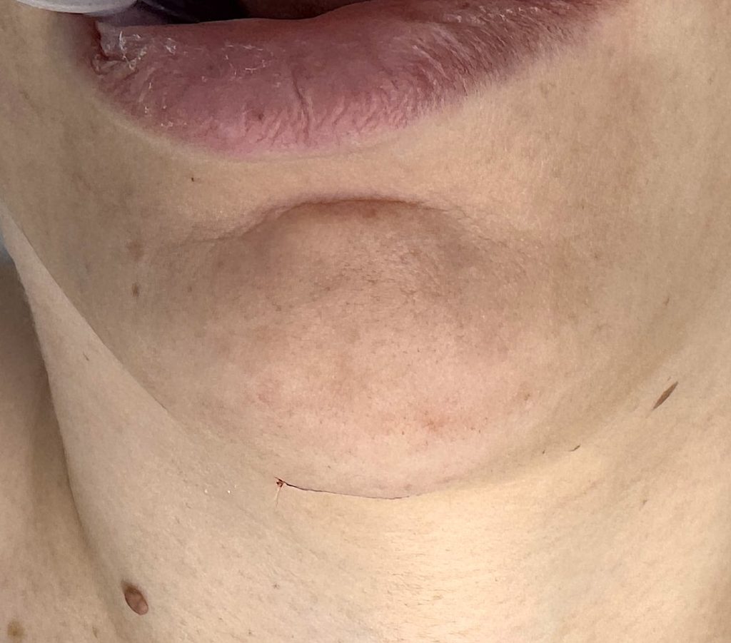 Plastic Surgery Case Study - Conversion of a Female Broad Standard Chin ...