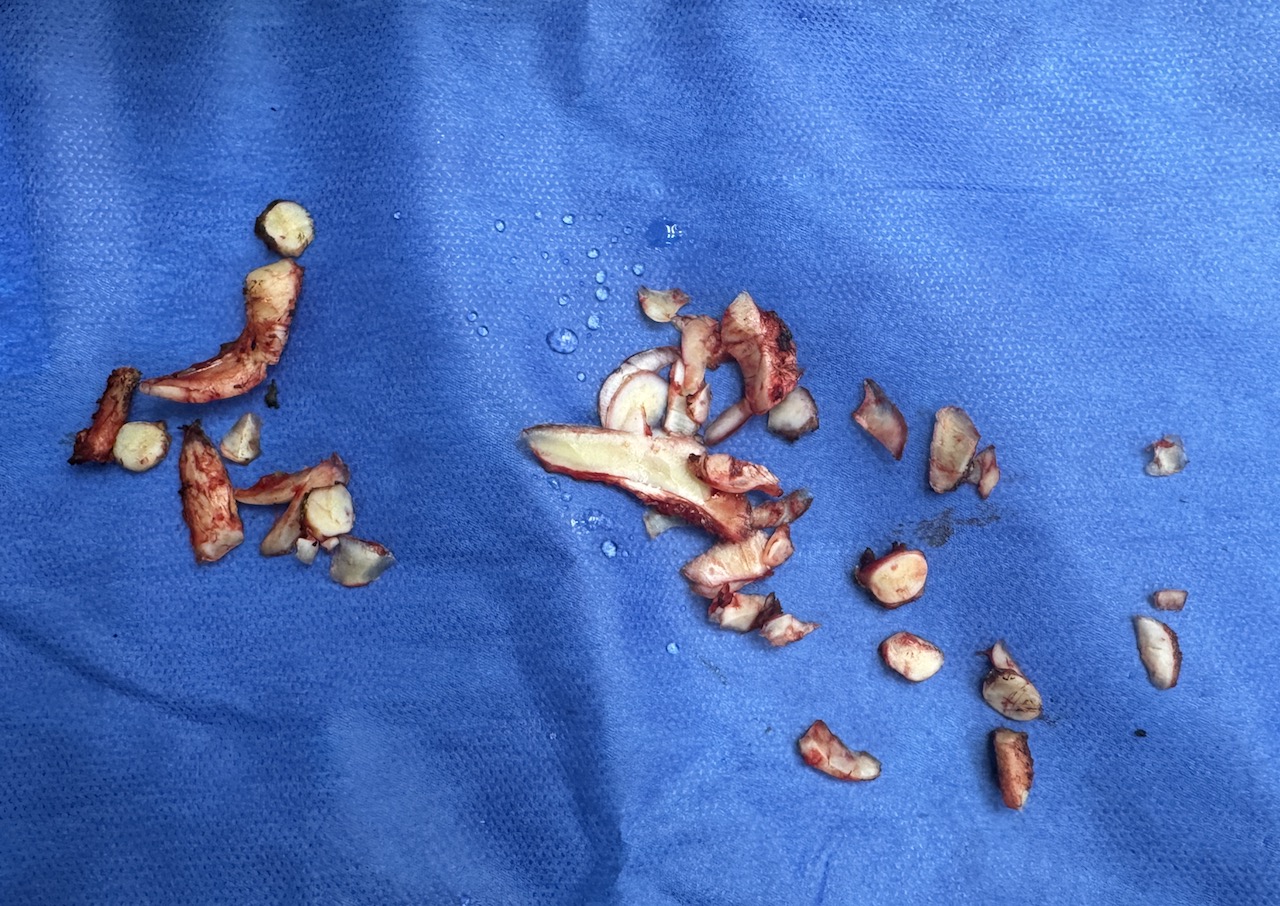 female left subcostal rib shaves Dr Barry Eppley - Explore Plastic Surgery