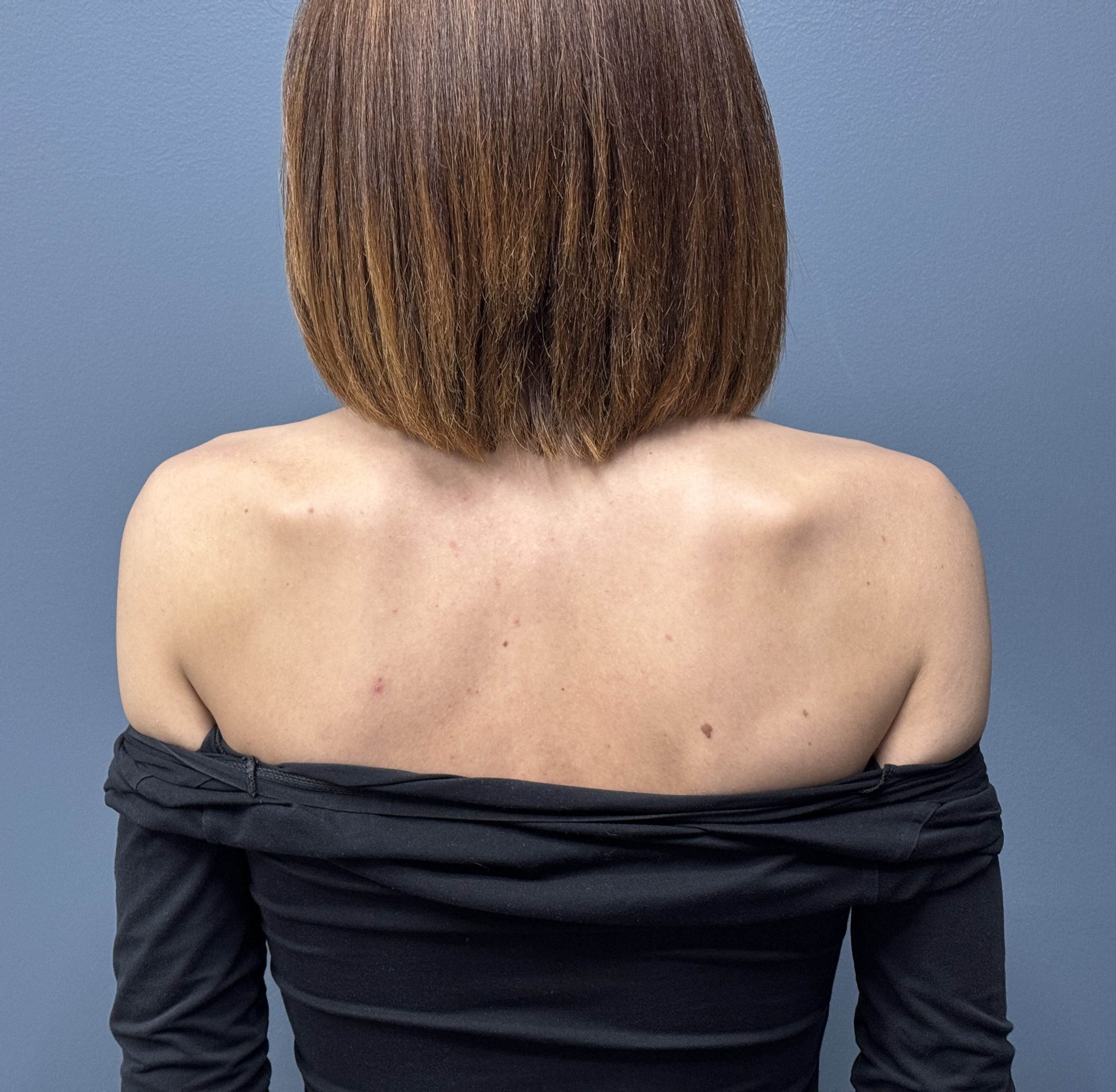 Plastic Surgery Case Study - Female Clavicle Reduction Osteotomies with ...