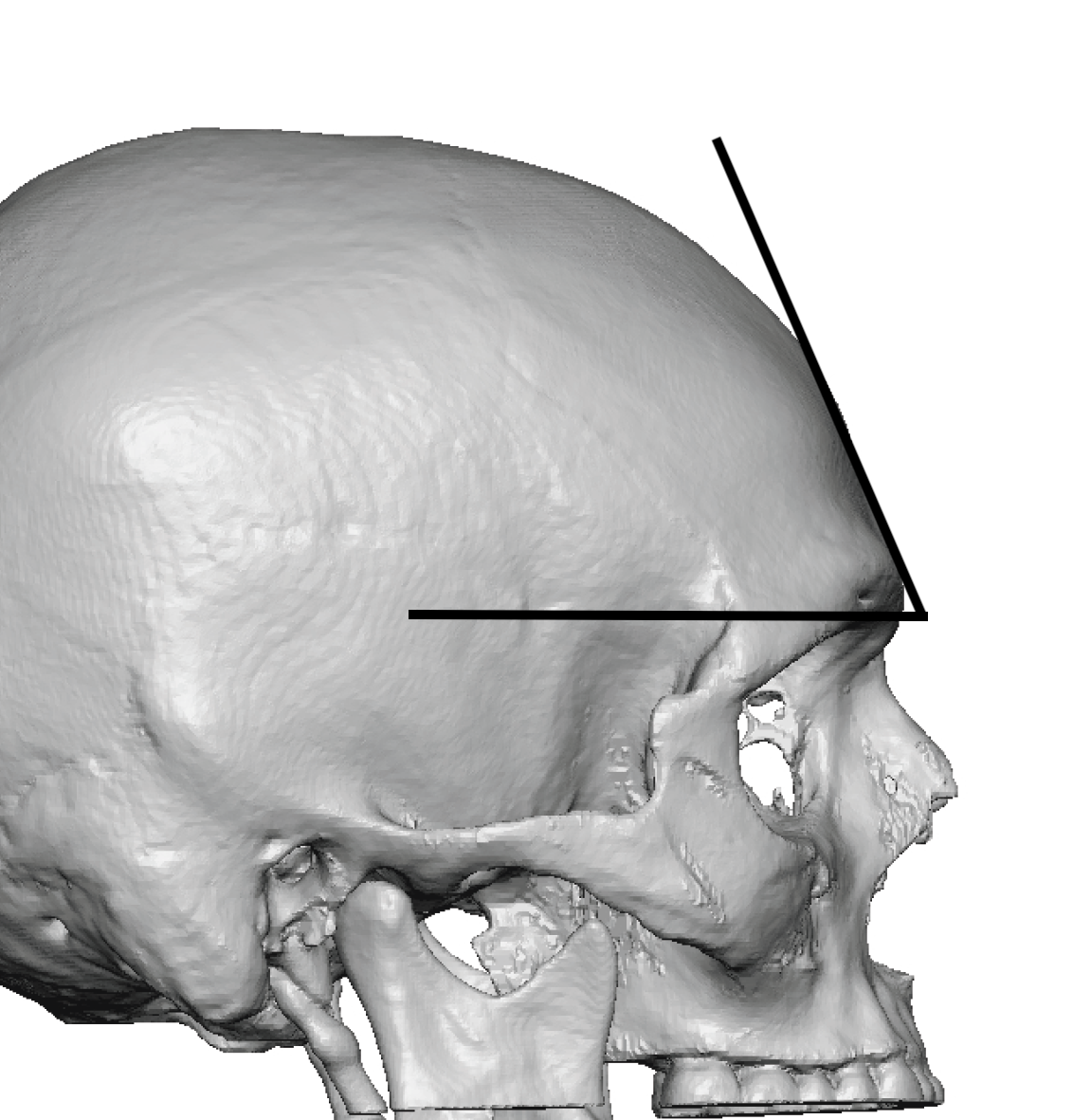 forehead inclination anglle Dr Barry Eppley - Explore Plastic Surgery
