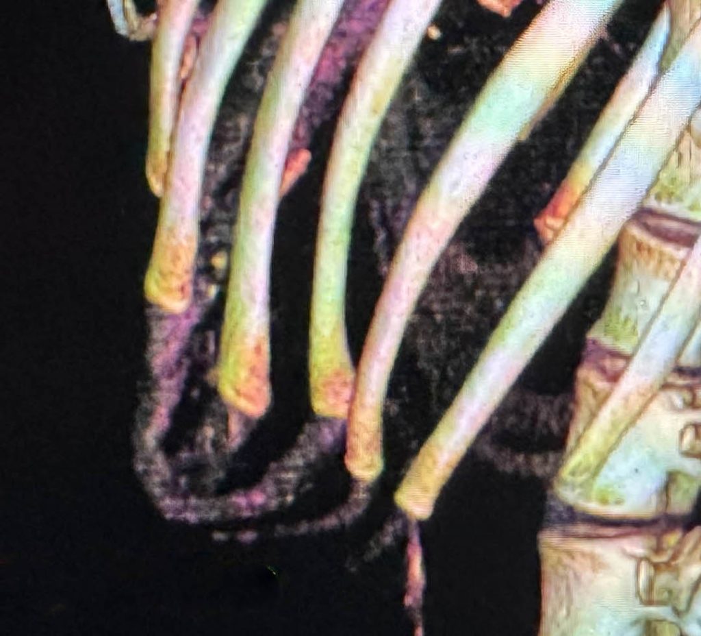 Plastic Surgery Case Study - Rib Remodeling for Right Subcostal Flare ...