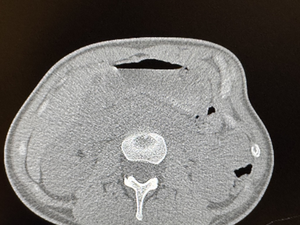 Plastic Surgery Case Study - Rib Remodeling for Right Subcostal Flare ...