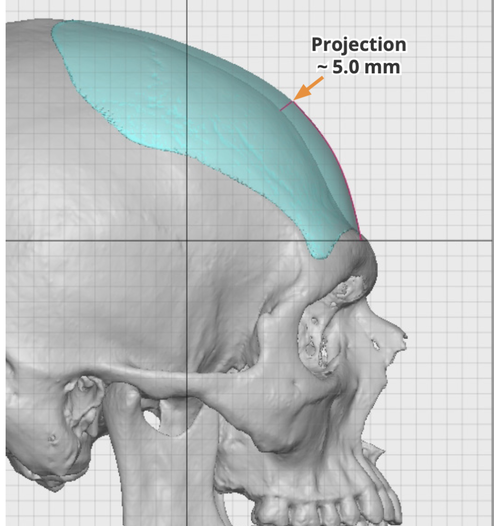 Plastic Surgery Case Study - Custom Forehead Implant for Male Pseudo ...