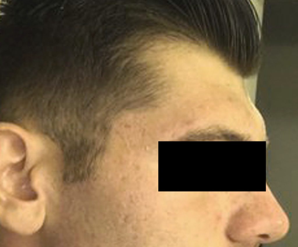 Plastic Surgery Case Study - Custom Forehead Implant for Male Pseudo ...