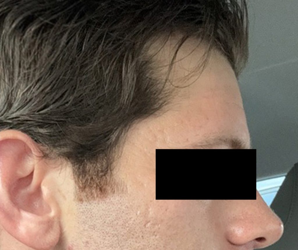 Plastic Surgery Case Study - Custom Forehead Implant for Male Pseudo ...