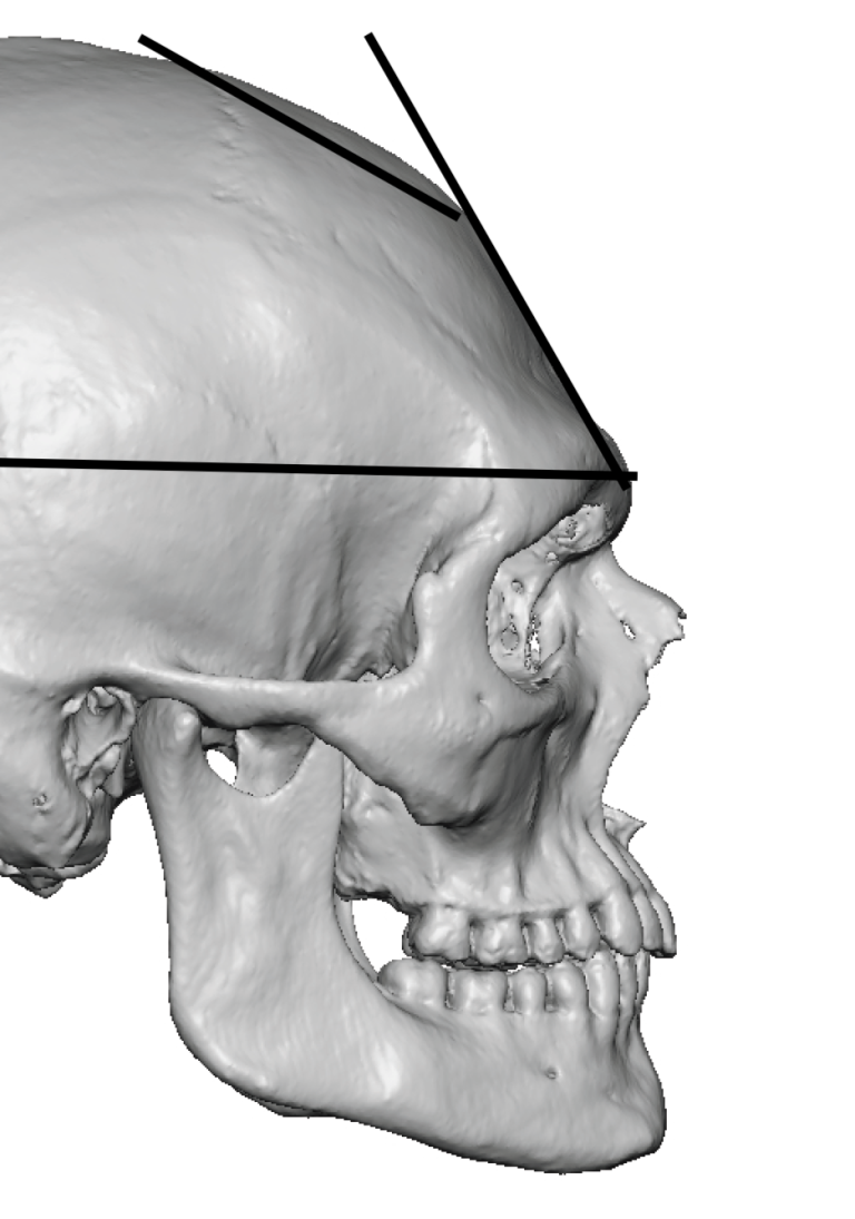 Plastic Surgery Case Study - Custom Forehead Implant for Male Pseudo ...