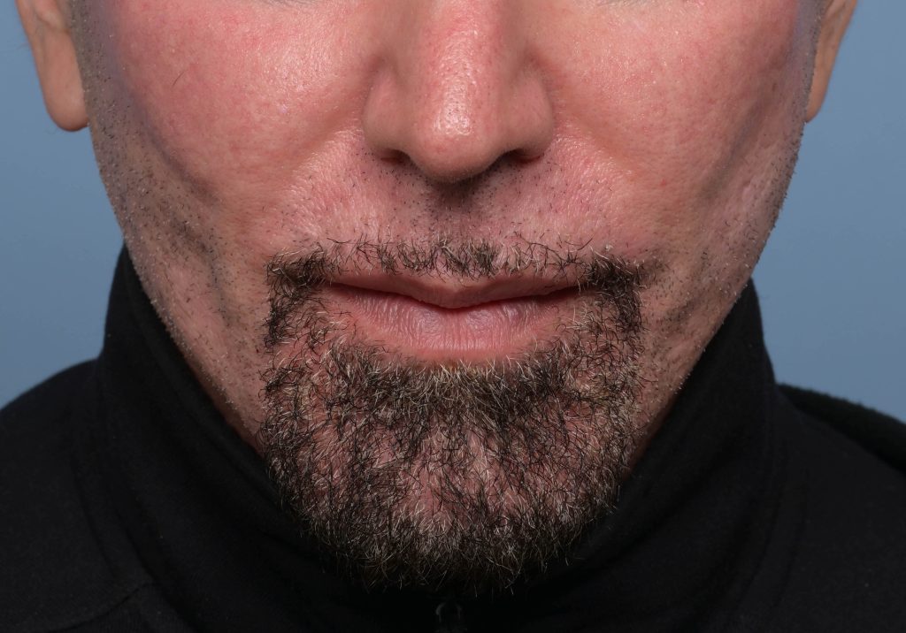 Plastic Surgery Case Study - Male ePTFE Paranasal Implants after Custom ...