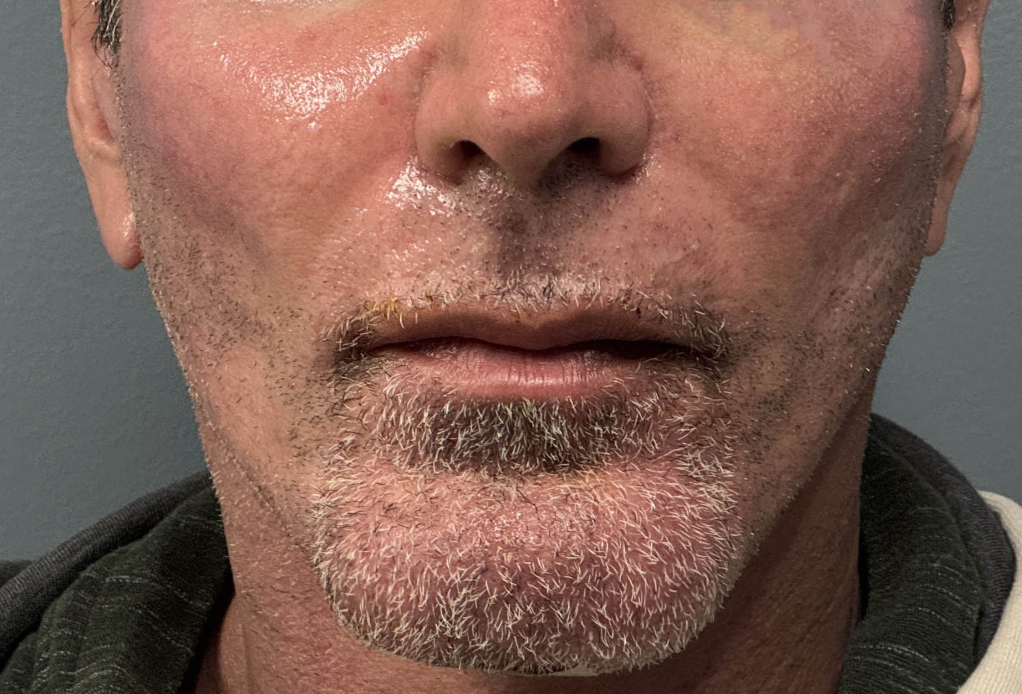 Plastic Surgery Case Study - Male ePTFE Paranasal Implants after Custom ...