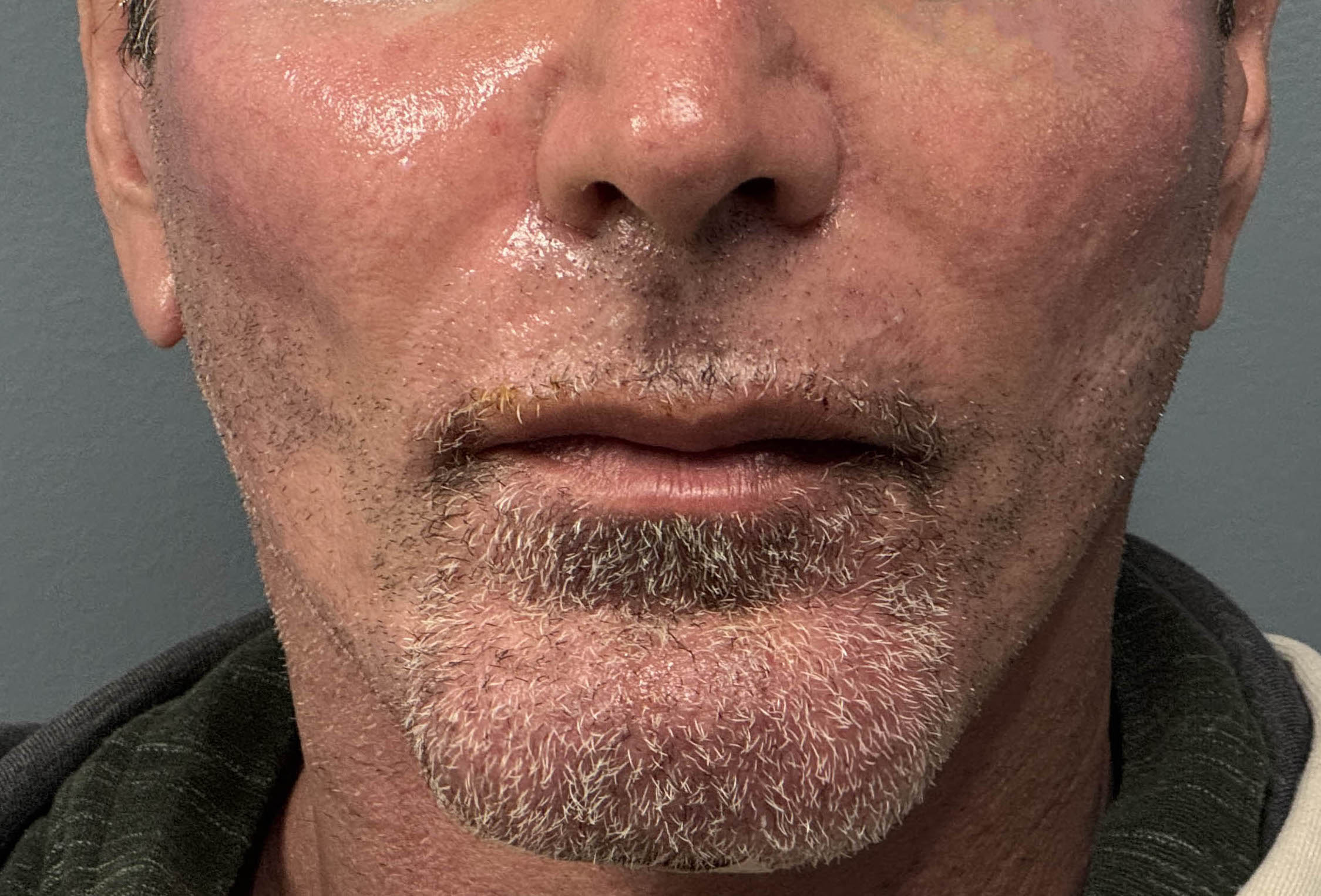 male paranasal implants front 2 Dr Barry Eppley_edited-1 - Explore ...